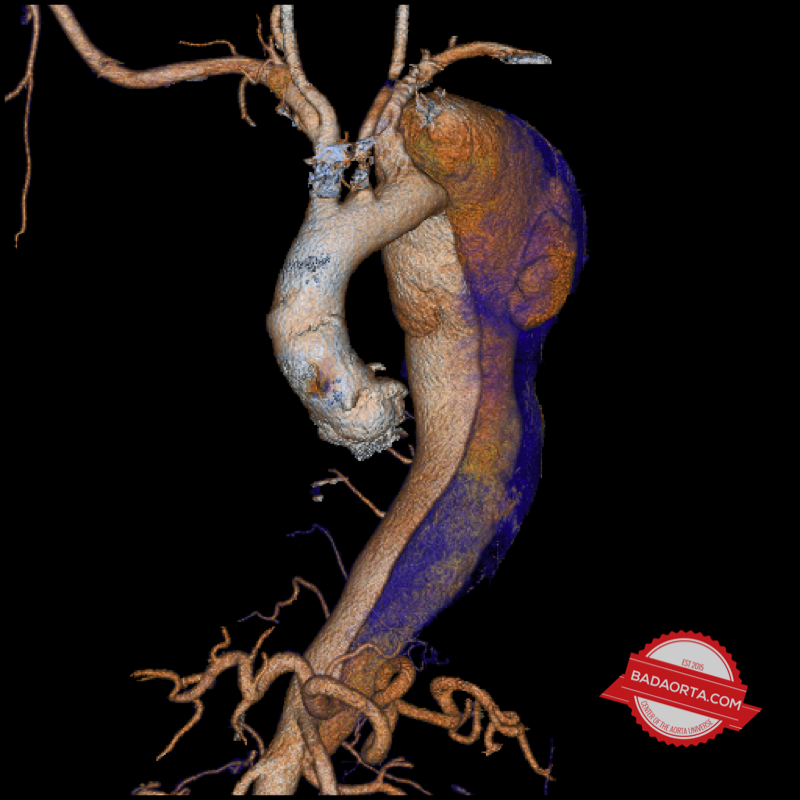 The Test of Time: Acute versus Chronic Aortic Dissections