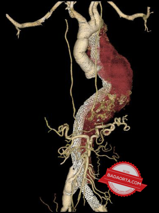 The Test of Time: Acute versus Chronic Aortic Dissections